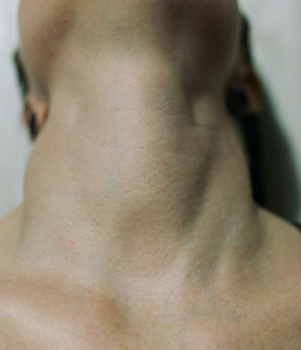 Recognizing and Treating Thyroid Storm - Manual of Medicine