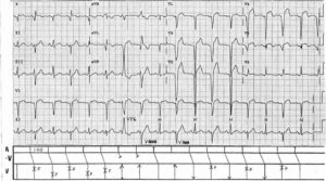 Anterior Wall MI and Ventricular Ectopic Focus with Fusion Complexes ...
