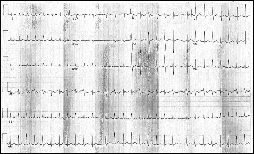 Atrial Flutter: ECG Interpretation [With Examples] - Manual of Medicine