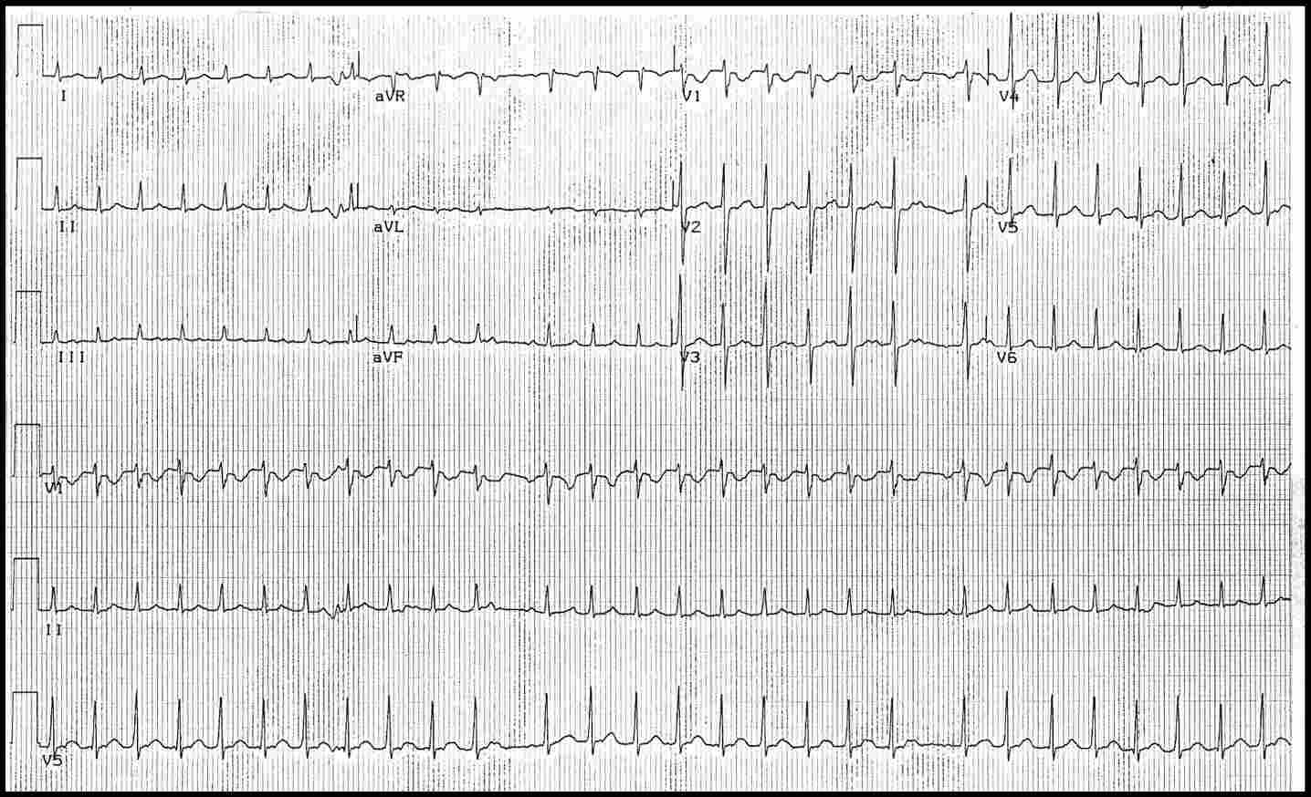 ECG Case 174: Hyperkalemia (Sine-Wave Pattern) - Manual of Medicine