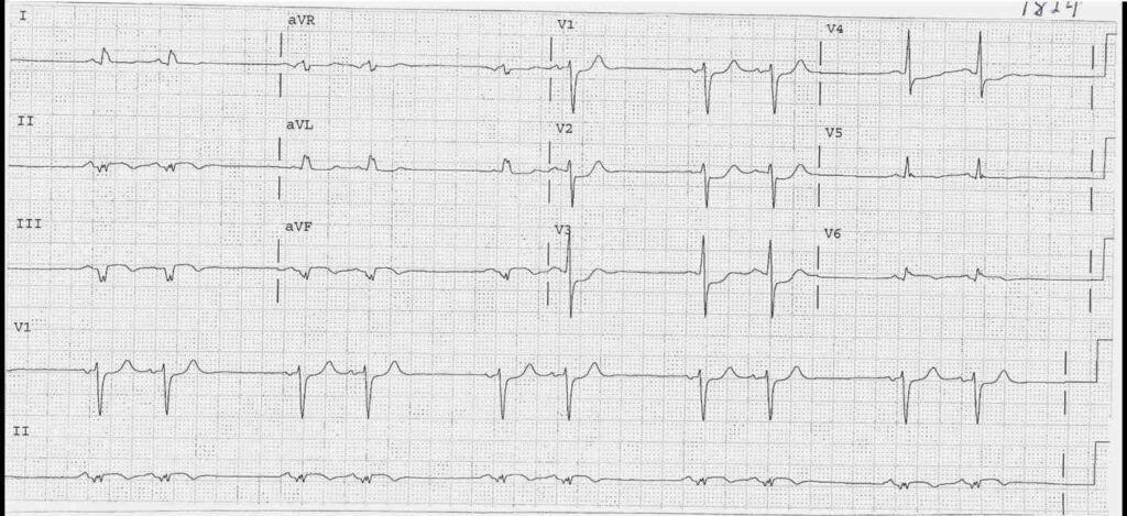 ECG Changes in Chronic Obstructive Pulmonary Disease (COPD) | Manual of ...