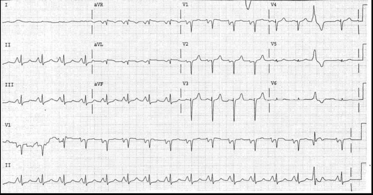 ECG Case 5 Interpretation - Chronic Obstructive Pulmonary Disease (COPD ...