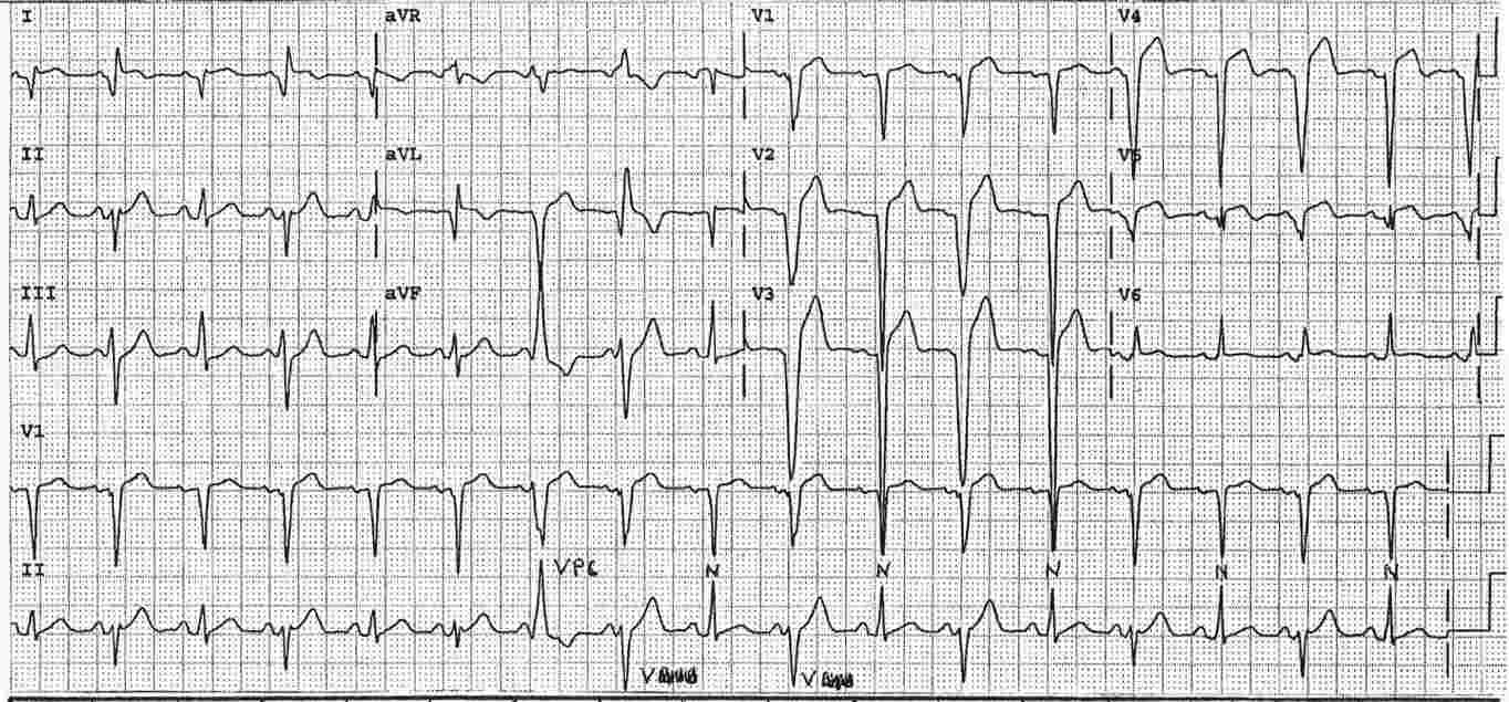 ECG Interpretation: All you need to know - Manual of Medicine