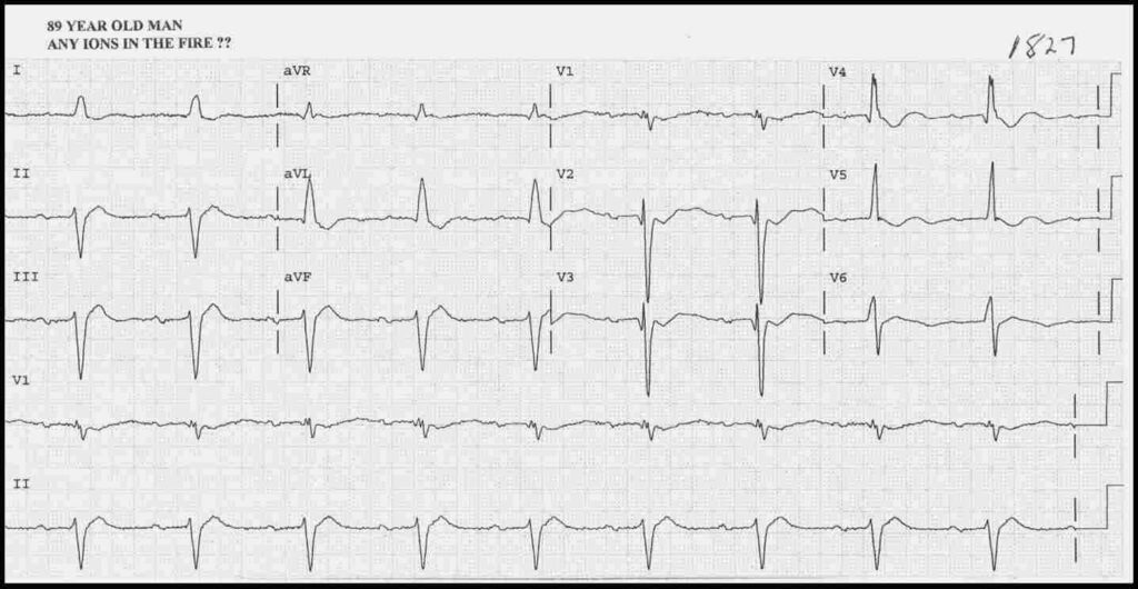 ECG Case 130: Atrial Flutter with 2:1 Conduction and RBBB - Manual of ...