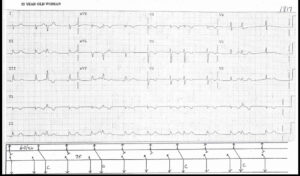 ECG Case 1 - Interpretation - Manual of Medicine