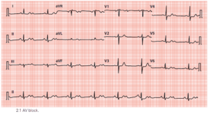Conduction Blocks at the AV Node (AV Blocks) [With Examples] - Manual ...