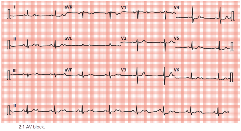 Conduction Blocks at the AV Node (AV Blocks) [With Examples] - Manual ...