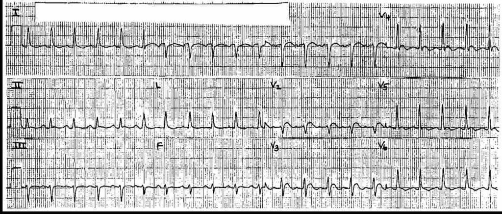 ECG Case 71: Atrial fibrillation with RVR, LAFB and Acute Anterolateral ...