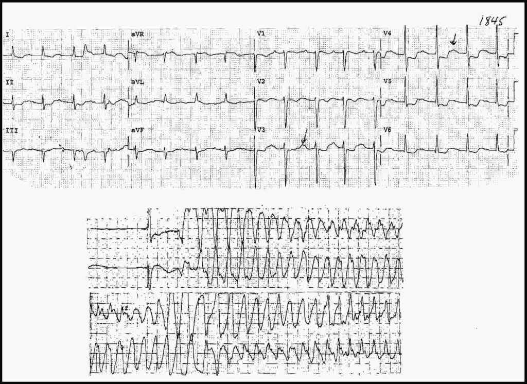 ECG Case 155: Sinus Tachycardia with Intraventricular Conduction Delay ...