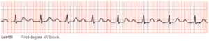 Conduction Blocks at the AV Node (AV Blocks) [With Examples] - Manual ...