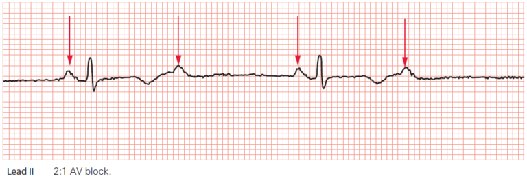 Conduction Blocks at the AV Node (AV Blocks) [With Examples] - Manual ...