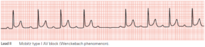 Conduction Blocks at the AV Node (AV Blocks) [With Examples] - Manual ...