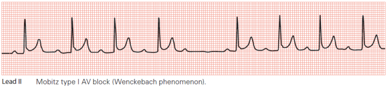 Do Not Confuse Mobitz Type I and Mobitz Type II Atrioventricular (AV ...