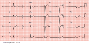 Conduction Blocks at the AV Node (AV Blocks) [With Examples] - Manual ...