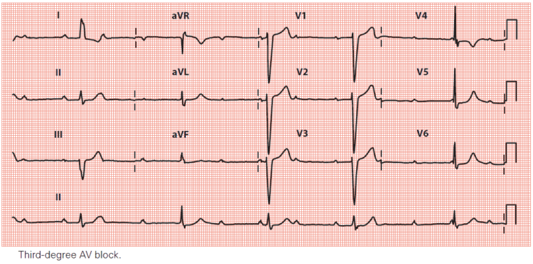 Conduction Blocks at the AV Node (AV Blocks) [With Examples] - Manual ...