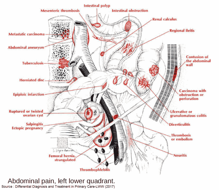 Lower Abdominal Pain in the Emergency Department - Manual of Medicine