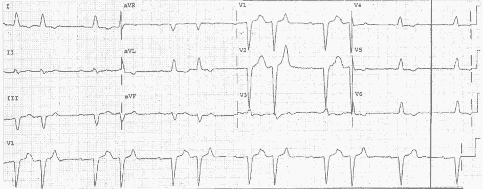 ECG Case 130: Atrial Flutter with 2:1 Conduction and RBBB - Manual of ...
