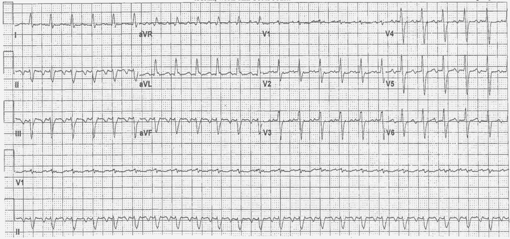 ECG Case 147: Digoxin Effect with Possible Digoxin Toxicity - Manual of ...