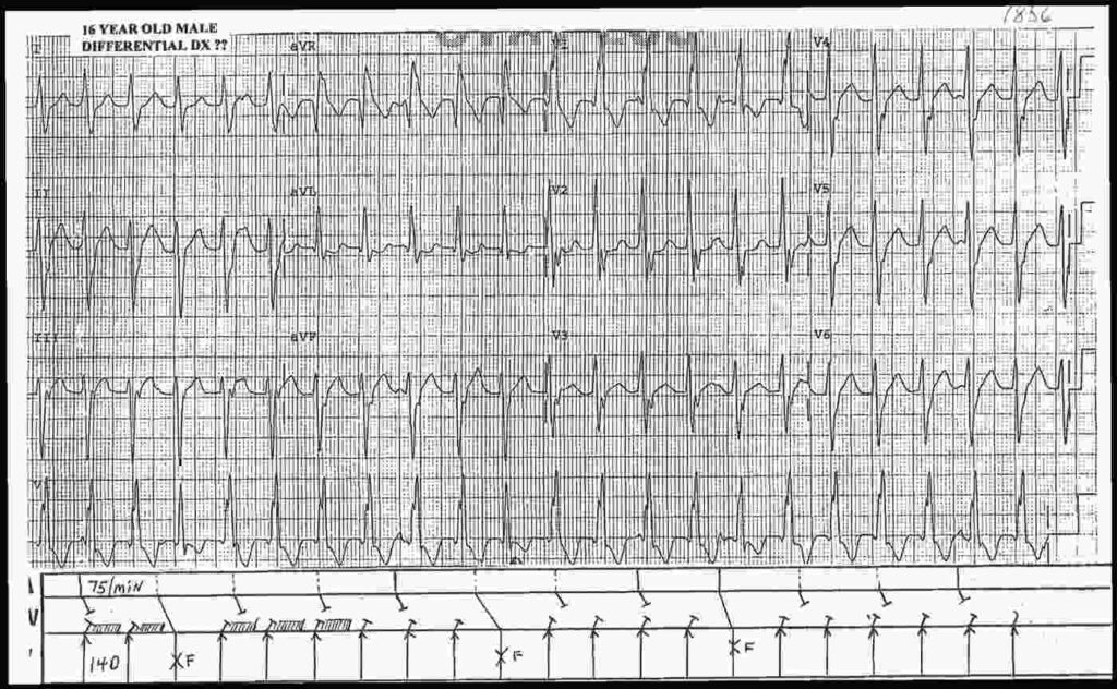 ECG Case 101 - Manual of Medicine