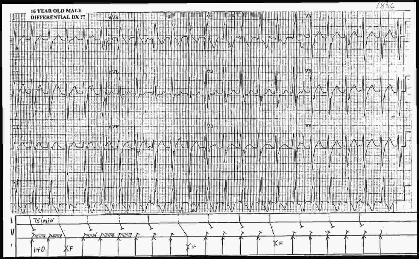 Idiopathic Posterior Fascicular Ventricular Tachycardia (VT) - Manual ...