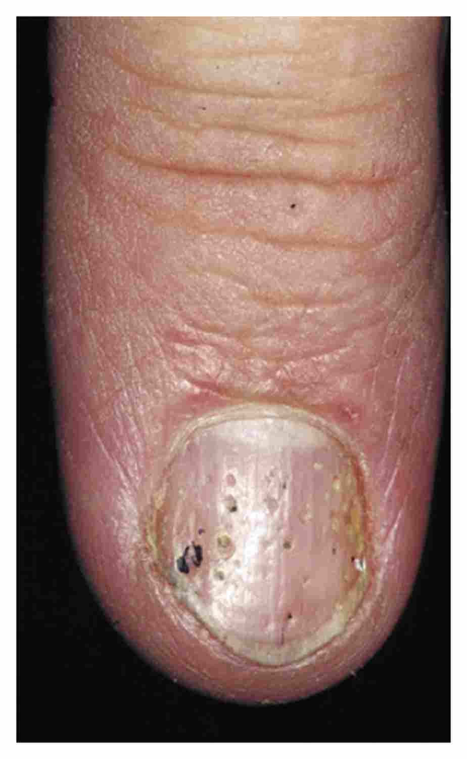 Nail Pitting - Manual of Medicine