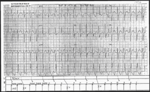 Idiopathic Posterior Fascicular Ventricular Tachycardia (VT) - Manual ...