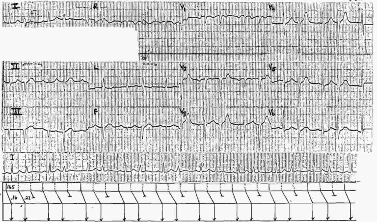 Atrial Flutter with 2:1 Conduction (2:1 AV Block) - Manual of Medicine
