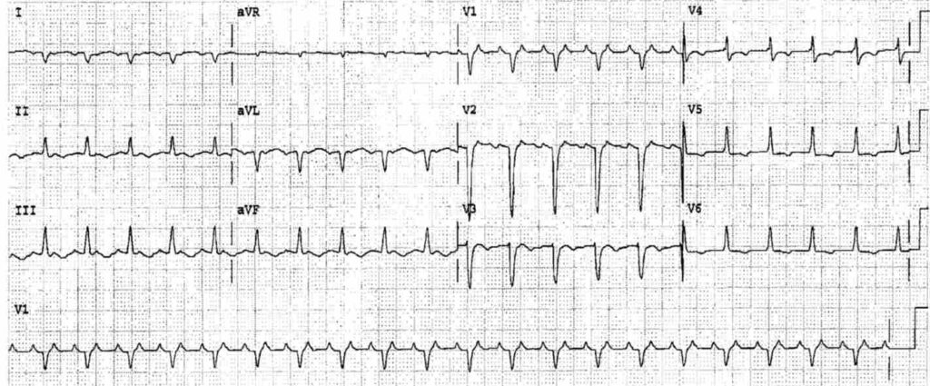 Conduction Blocks at the AV Node (AV Blocks) - Manual of Medicine