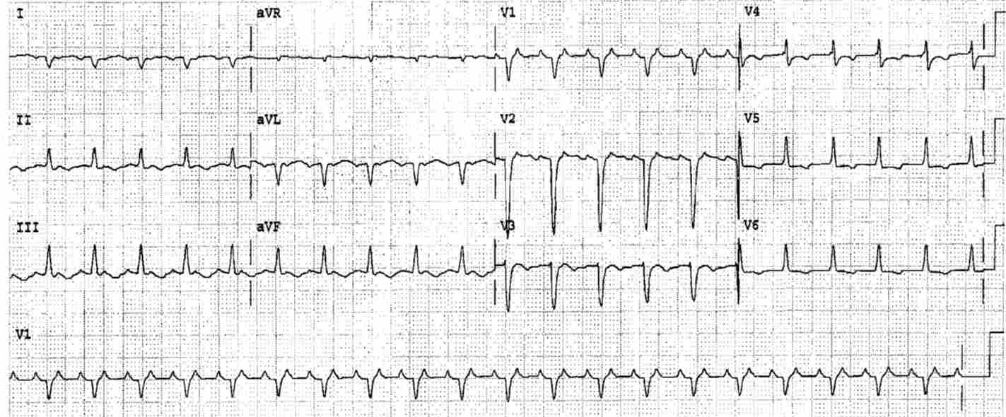 ECG Case 150: Atrial Fibrillation with Rapid Ventricular Response (RVR ...