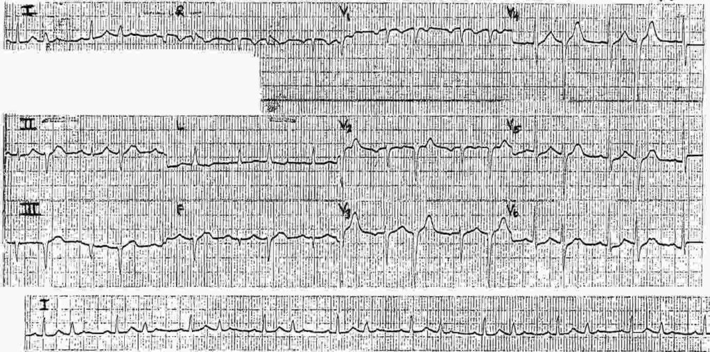 ECG Case 71: Atrial fibrillation with RVR, LAFB and Acute Anterolateral ...
