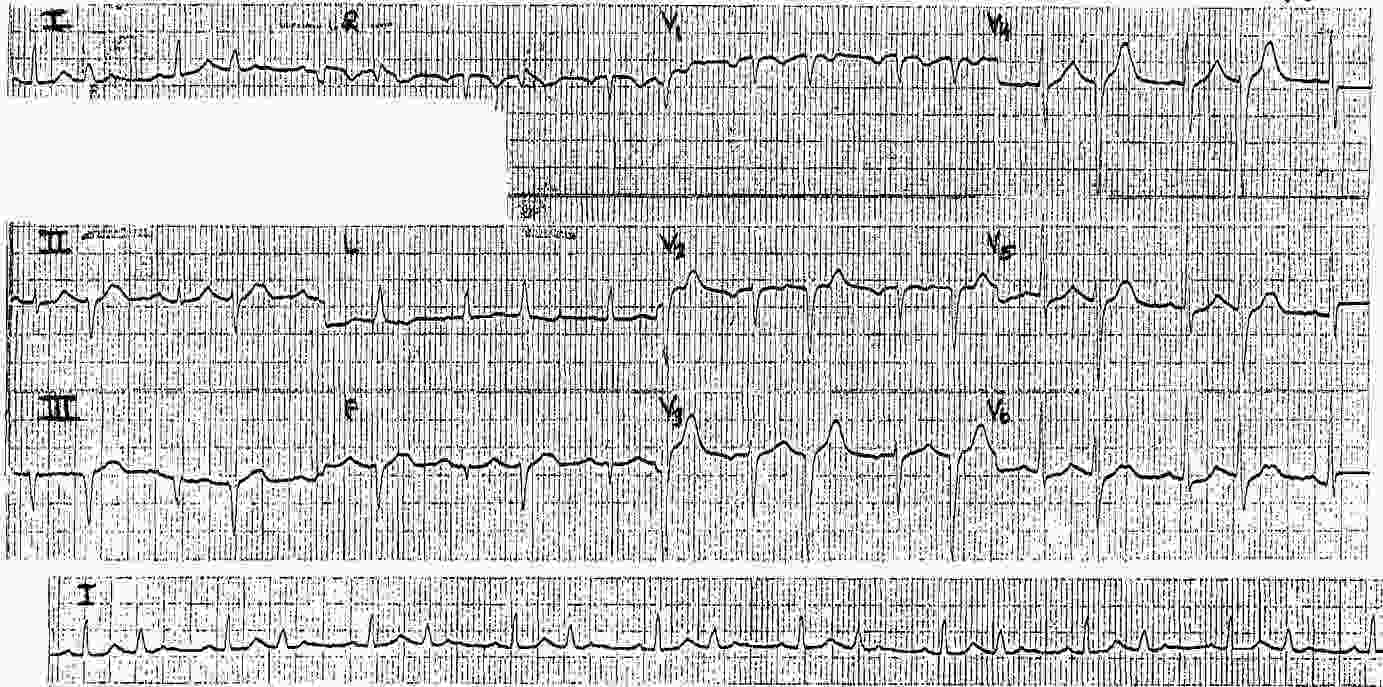 ECG Interpretation: All you need to know - Manual of Medicine