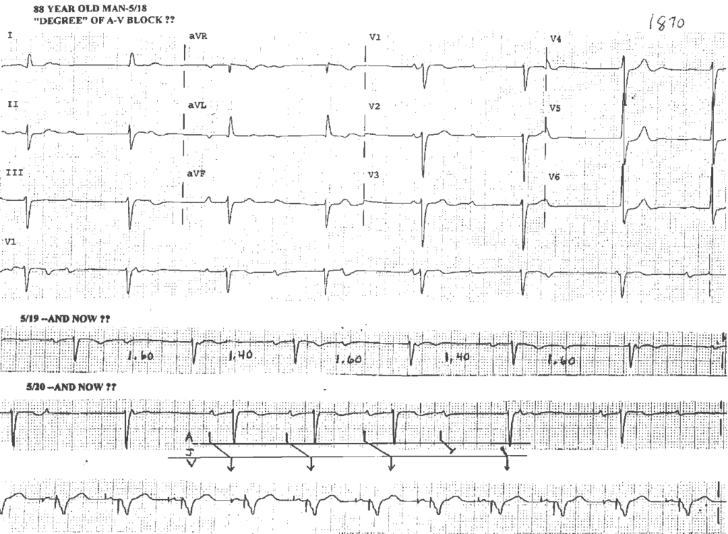 Atrial Flutter with 2:1 Conduction (2:1 AV Block) - Manual of Medicine