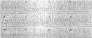 ECG Case 33 - Manual of Medicine