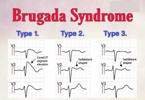 ECG Case 112: Brugada Syndrome - Manual of Medicine