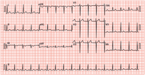 Left Ventricular Hypertrophy (LVH): How to Recognize it on ECG [With ...