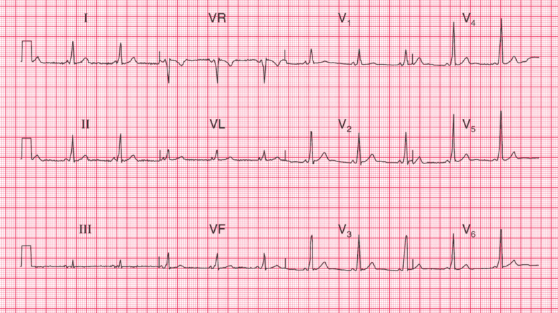 ECG Case 171: Electrical Alternans indicating Pericardial Effusion ...
