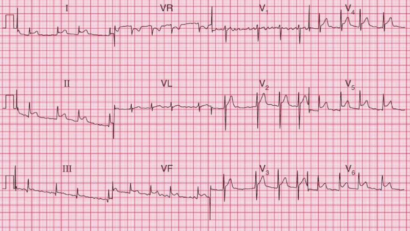 ECG Case 81: Atrial Flutter with 4 : 1 AV Block - Manual of Medicine