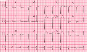 ECG Case 106: Left Atrial and Left Ventricular Hypertrophy (LVH ...