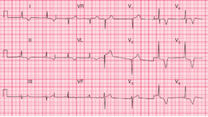 ECG Case 108: Hypertrophic Cardiomyopathy - Manual of Medicine