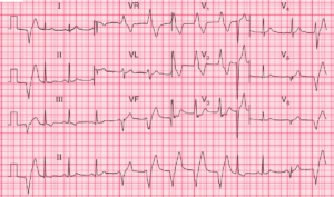ECG Case 110: Sinus Rhythm and Accelerated Idioventricular Rhythm ...