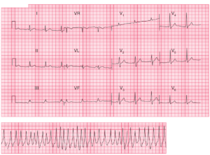 ECG Case 113: WPW Syndrome Type A, with Paroxysmal Atrial Fibrillation ...