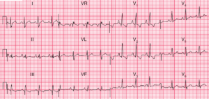 ECG Case 115: Right Atrial and Right Ventricular Hypertrophy - Manual ...