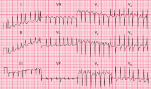 ECG Case 116: Atrial Fibrillation with a Rapid Ventricular Rate and ...