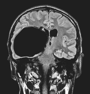 Incidental Finding on MRI in a 22-year-old man - Manual of Medicine