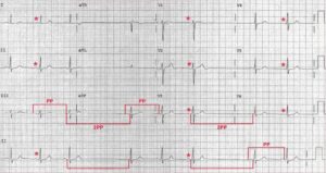 ECG Case 118: Sinus Node Exit Block - Manual of Medicine