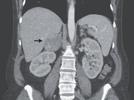 Cushing’s syndrome - Manual of Medicine