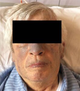 Blue-grey Discoloration of Nose, Cheeks, and Forehead - Manual of Medicine