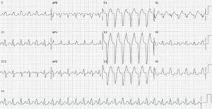 ECGs Archives - Manual of Medicine