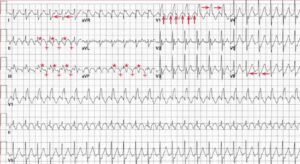 Ecg Case 130 Atrial Flutter With 2 1 Conduction And Rbbb Manual Of