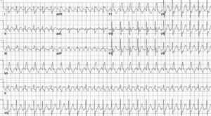 ECGs Archives - Manual of Medicine